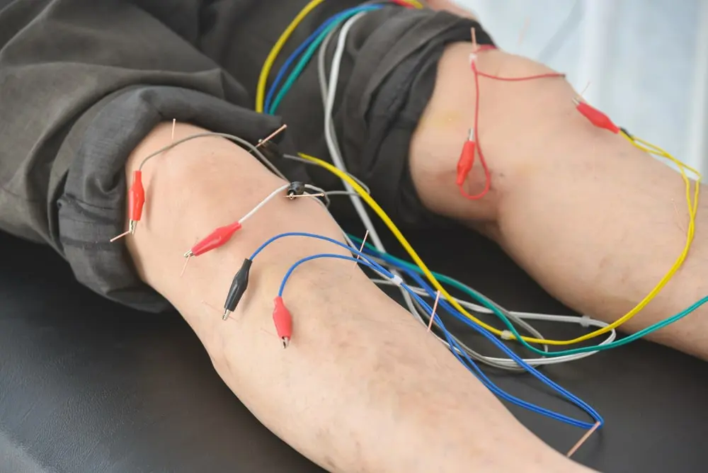 Electroacupuncture & E-Stim - Acupuncture in Chattanooga
